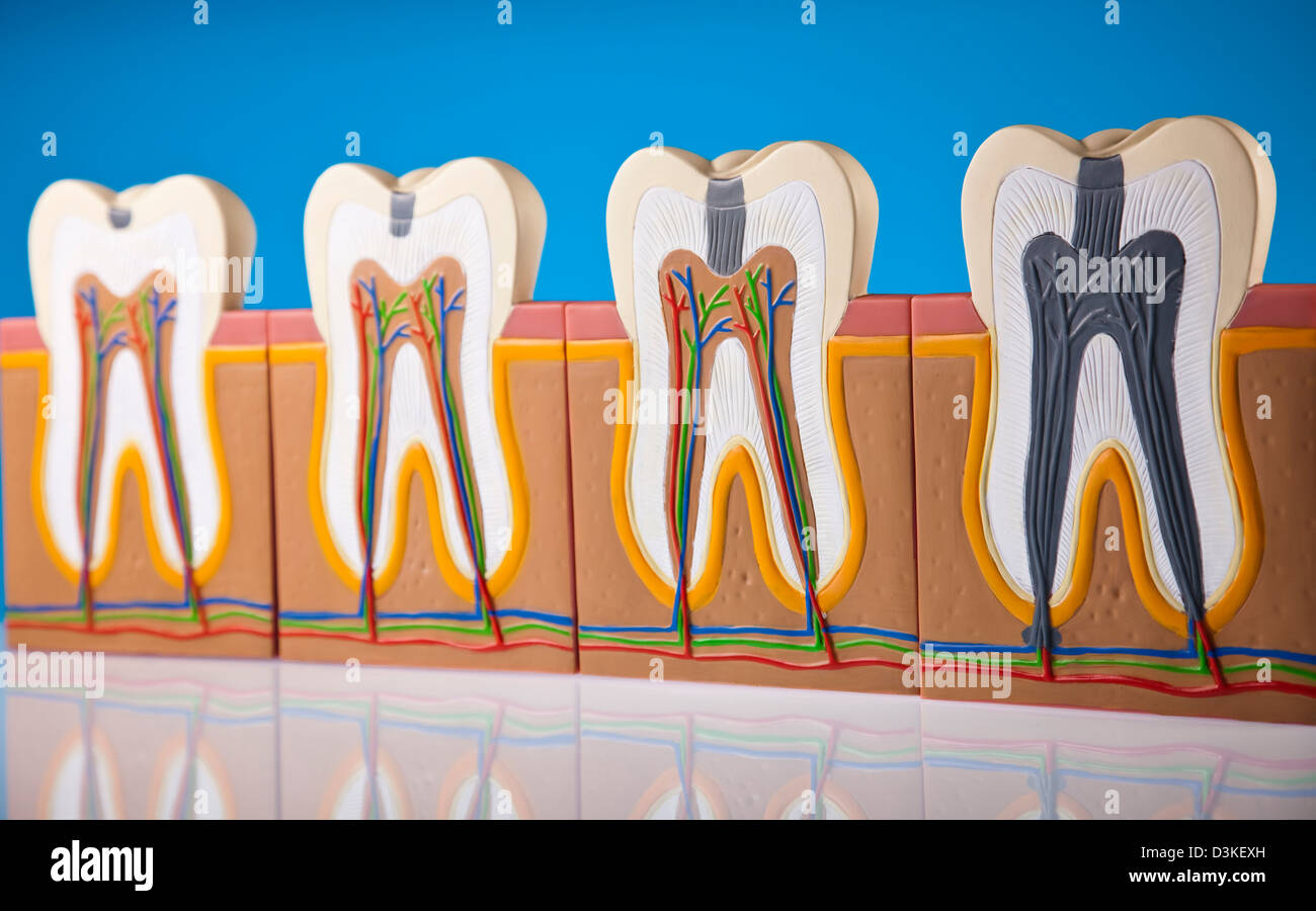 Anatomy of the teeth with caries Stock Photo - Alamy