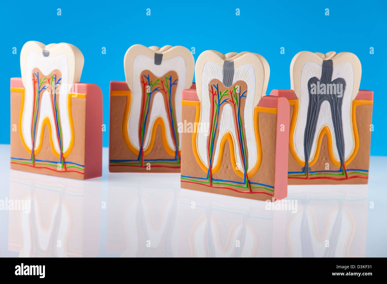 Human tooth structure with caries Stock Photo - Alamy