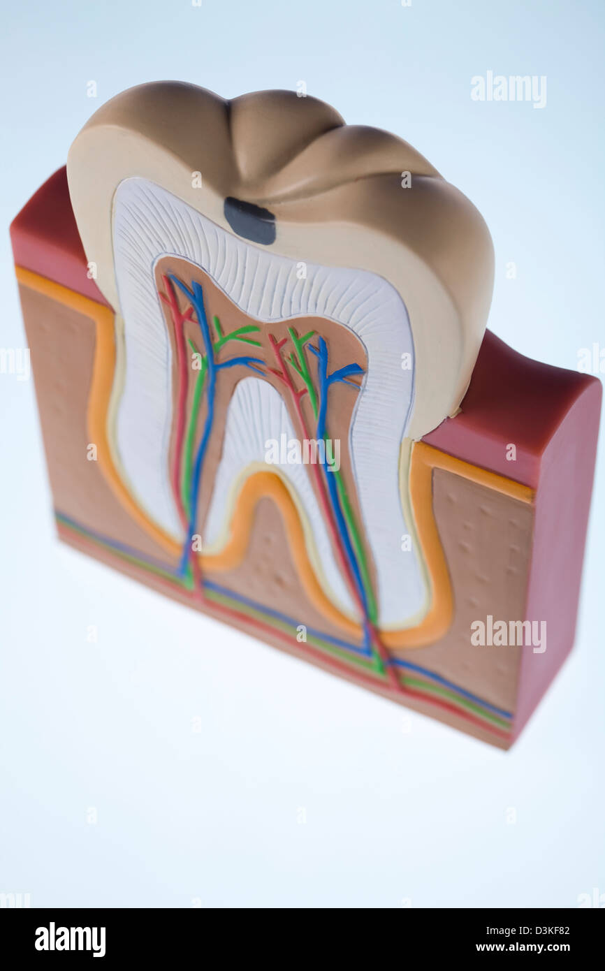 Human tooth structure with caries Stock Photo - Alamy