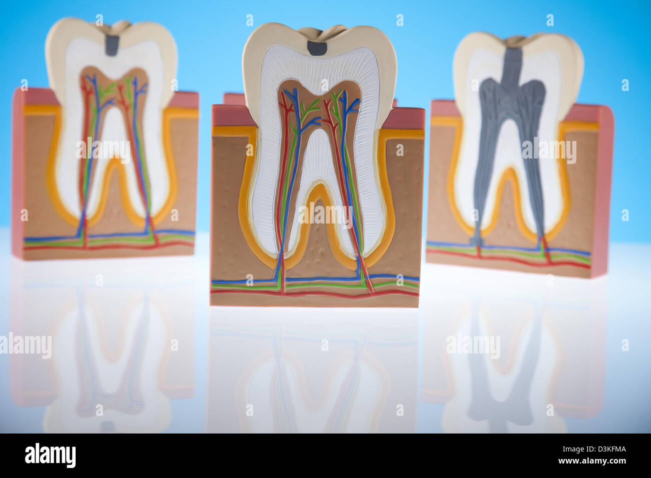 Human tooth structure with caries Stock Photo - Alamy
