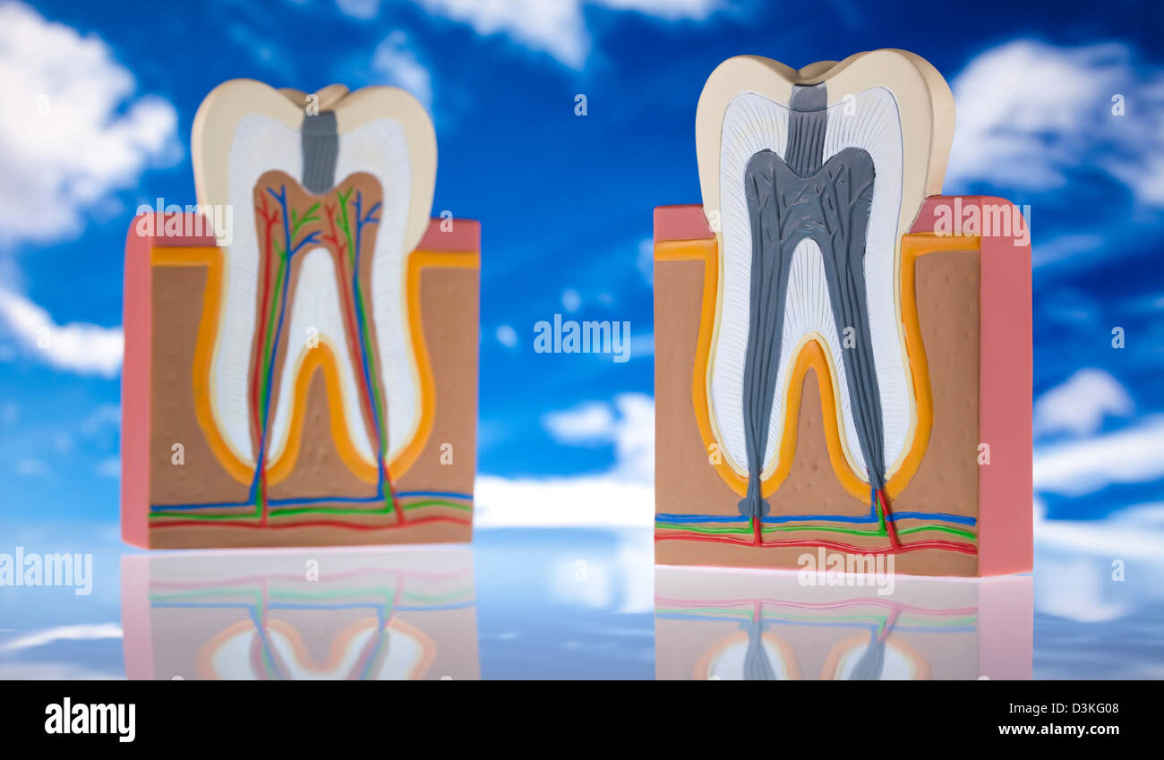 Human tooth structure with caries,blue sky Stock Photo - Alamy