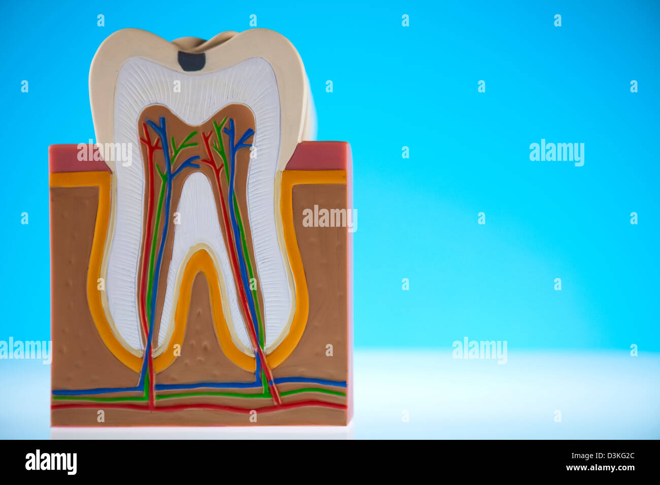 Human tooth structure with caries Stock Photo - Alamy