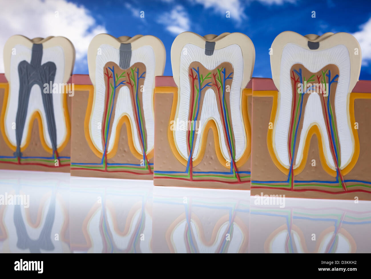 Human tooth structure with caries,blue sky Stock Photo - Alamy