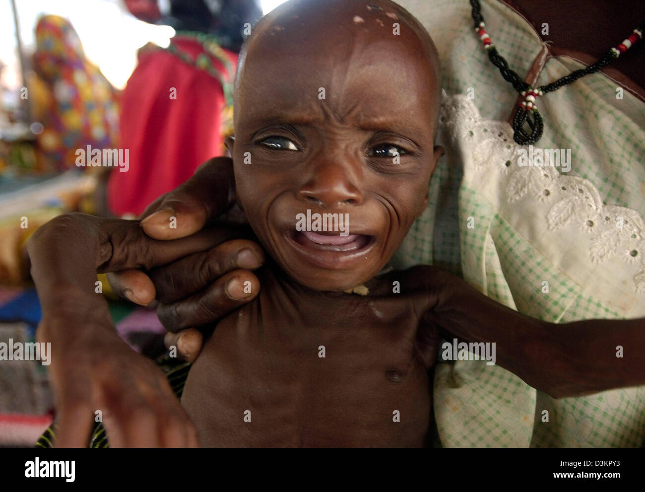 (dpa) - A child suffering from severe malnutrition cries in the ...