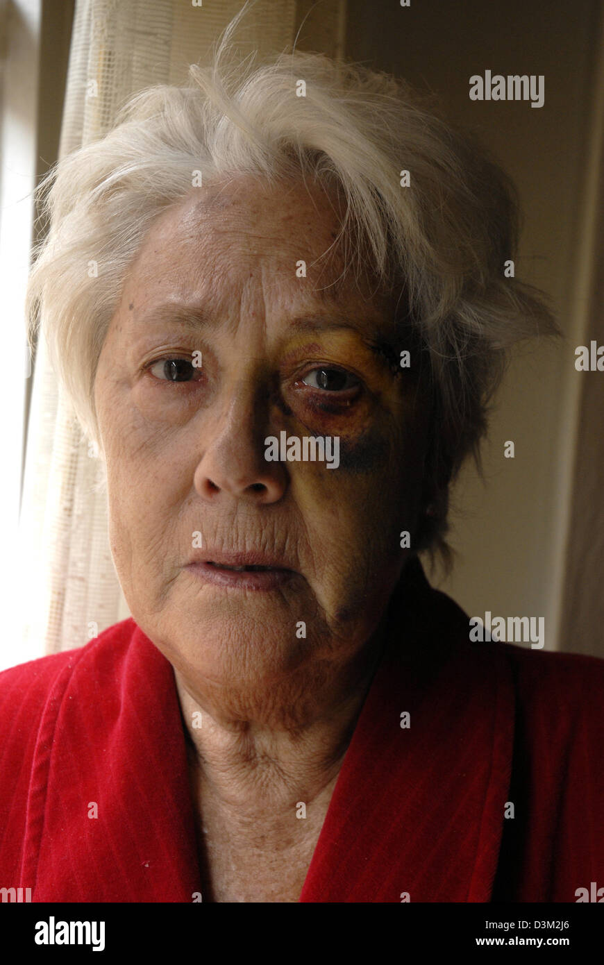 Battered woman battered woman black eye hi-res stock photography and ...