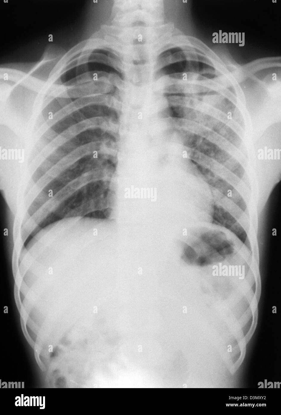 Xray Of The Thorax In Tuberculosis Radlinesorg The Radiology Assistant