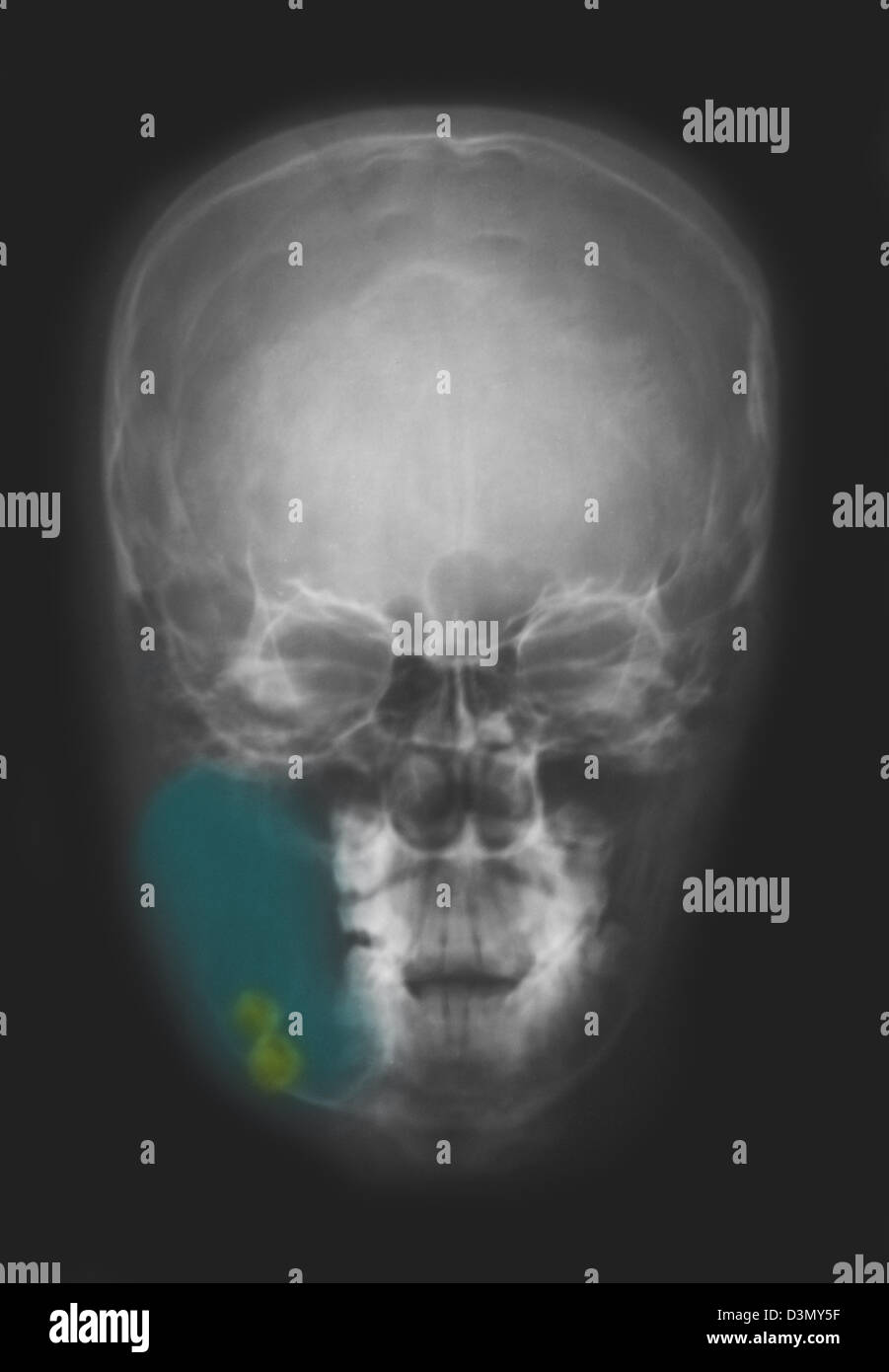 skull x-ray showing a dentigerous bone cyst Stock Photo - Alamy