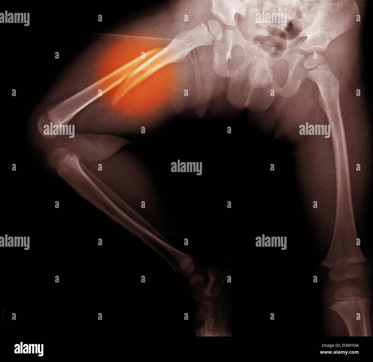 x-ray showing a femur fracture in a 3 year old boy, a victim of child ...
