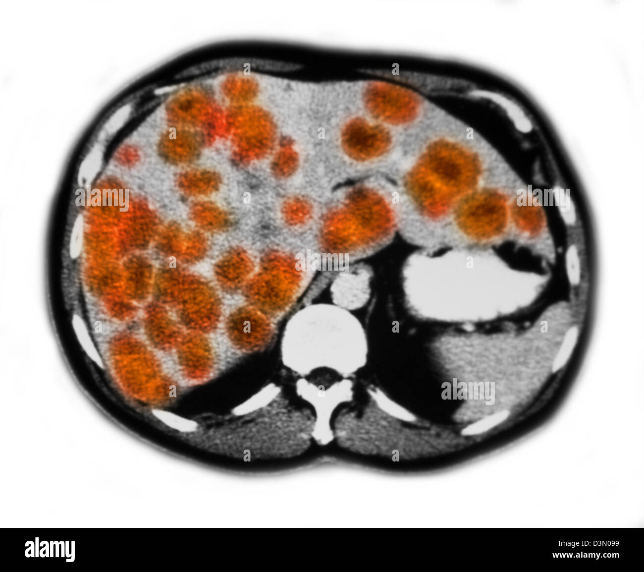 Liver Cancer Scan High Resolution Stock Photography and Images - Alamy