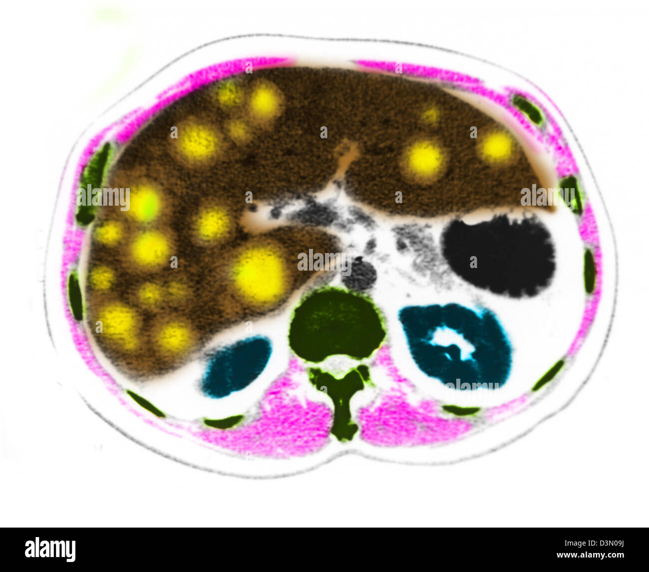 Liver Cancer Scan High Resolution Stock Photography and Images - Alamy