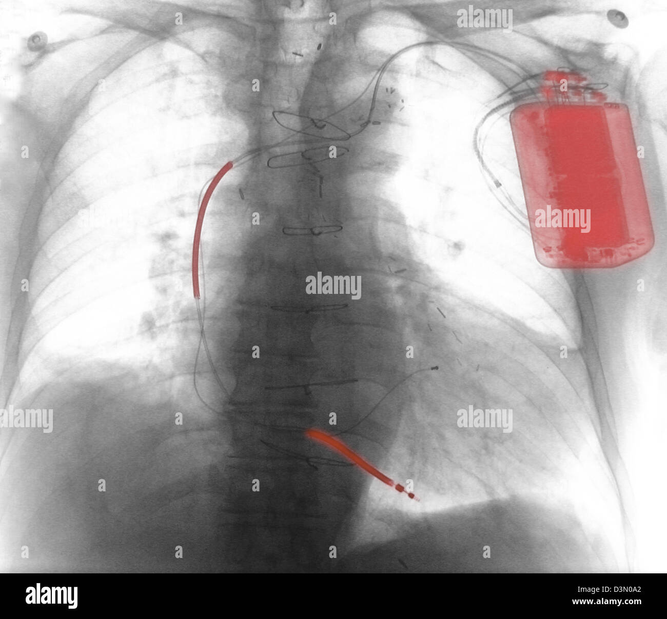 Chest x-ray showing an implanted defibrillator Stock Photo - Alamy