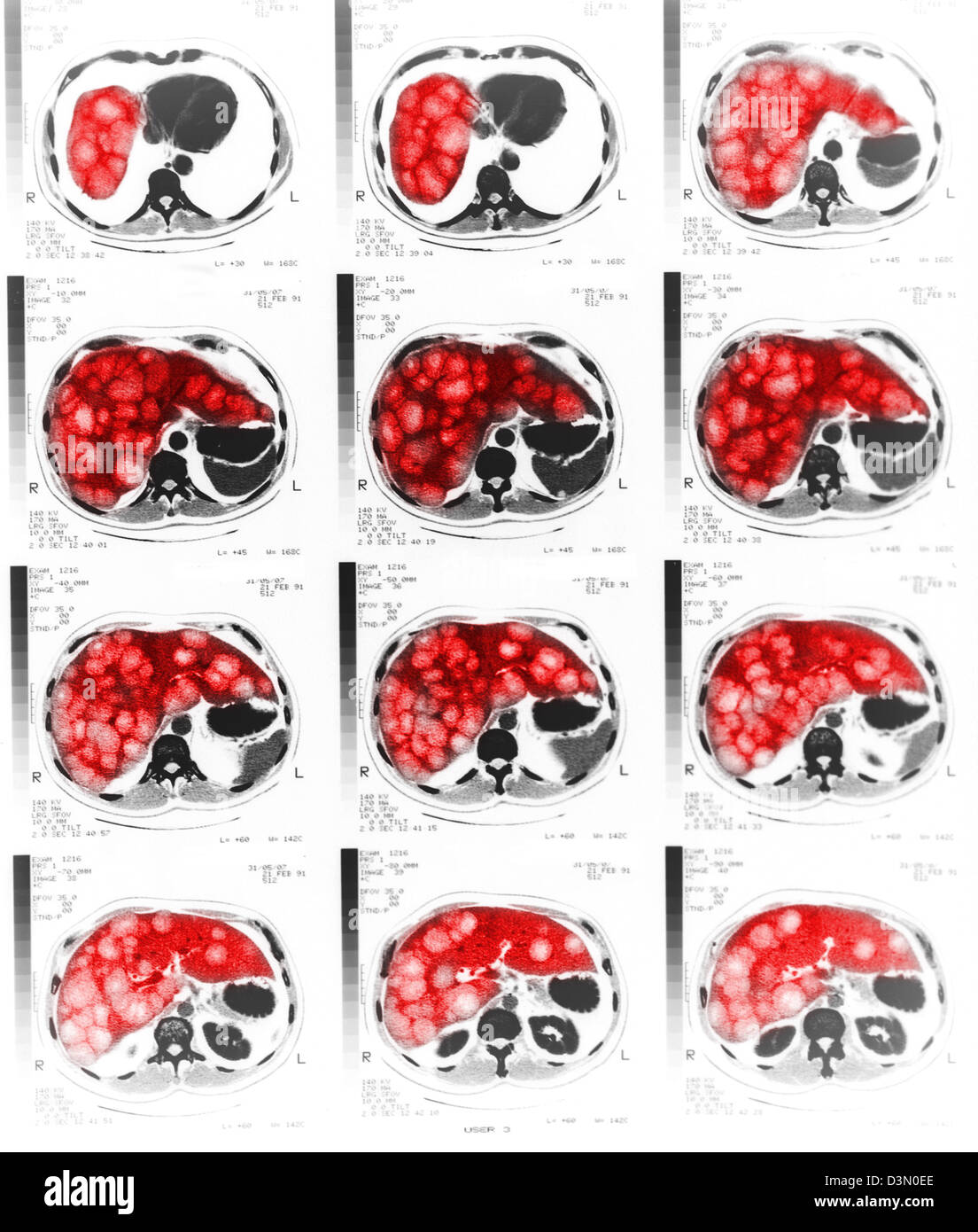 Liver cancer hi-res stock photography and images - Alamy