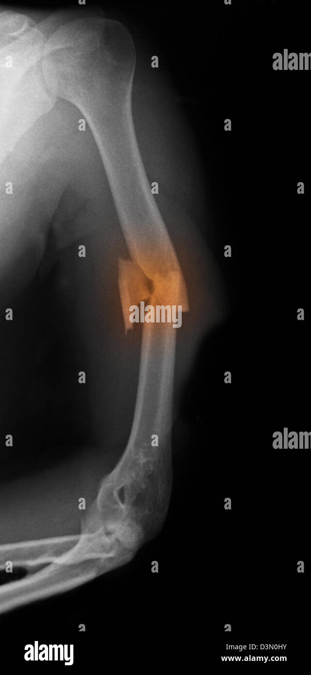 Humerus X Ray Intraoperative Imaging Of The Proximal Humerus