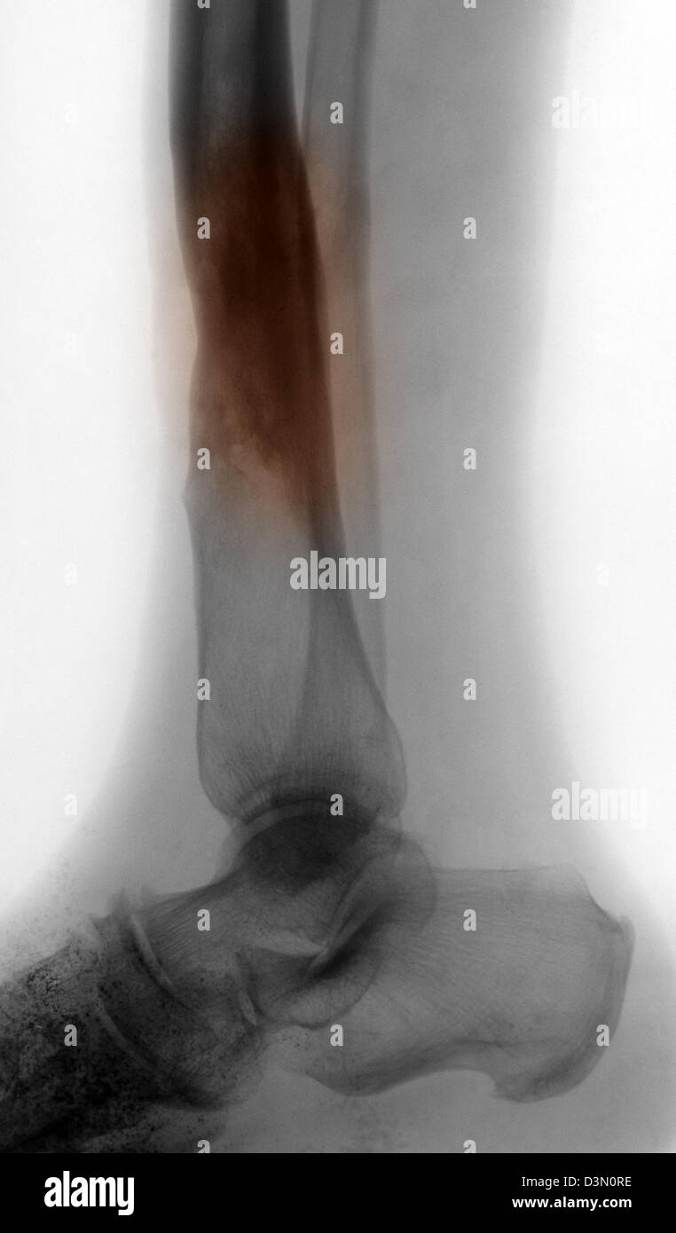 An open fracture hi-res stock photography and images - Alamy