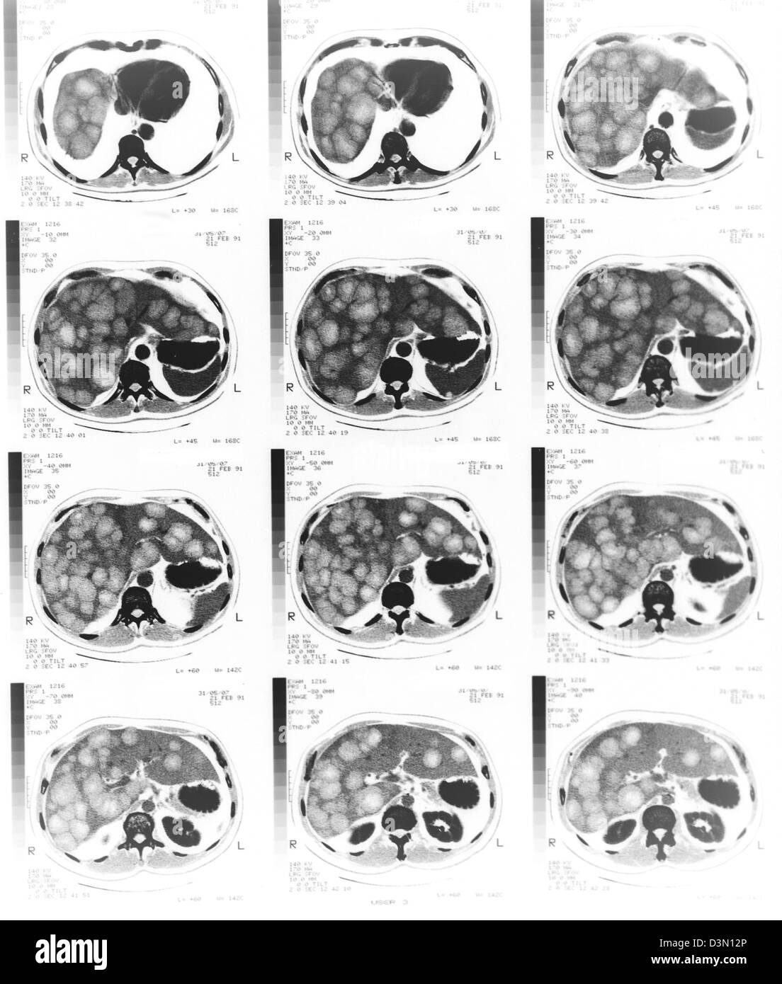 Liver Cancer Scan High Resolution Stock Photography and Images - Alamy