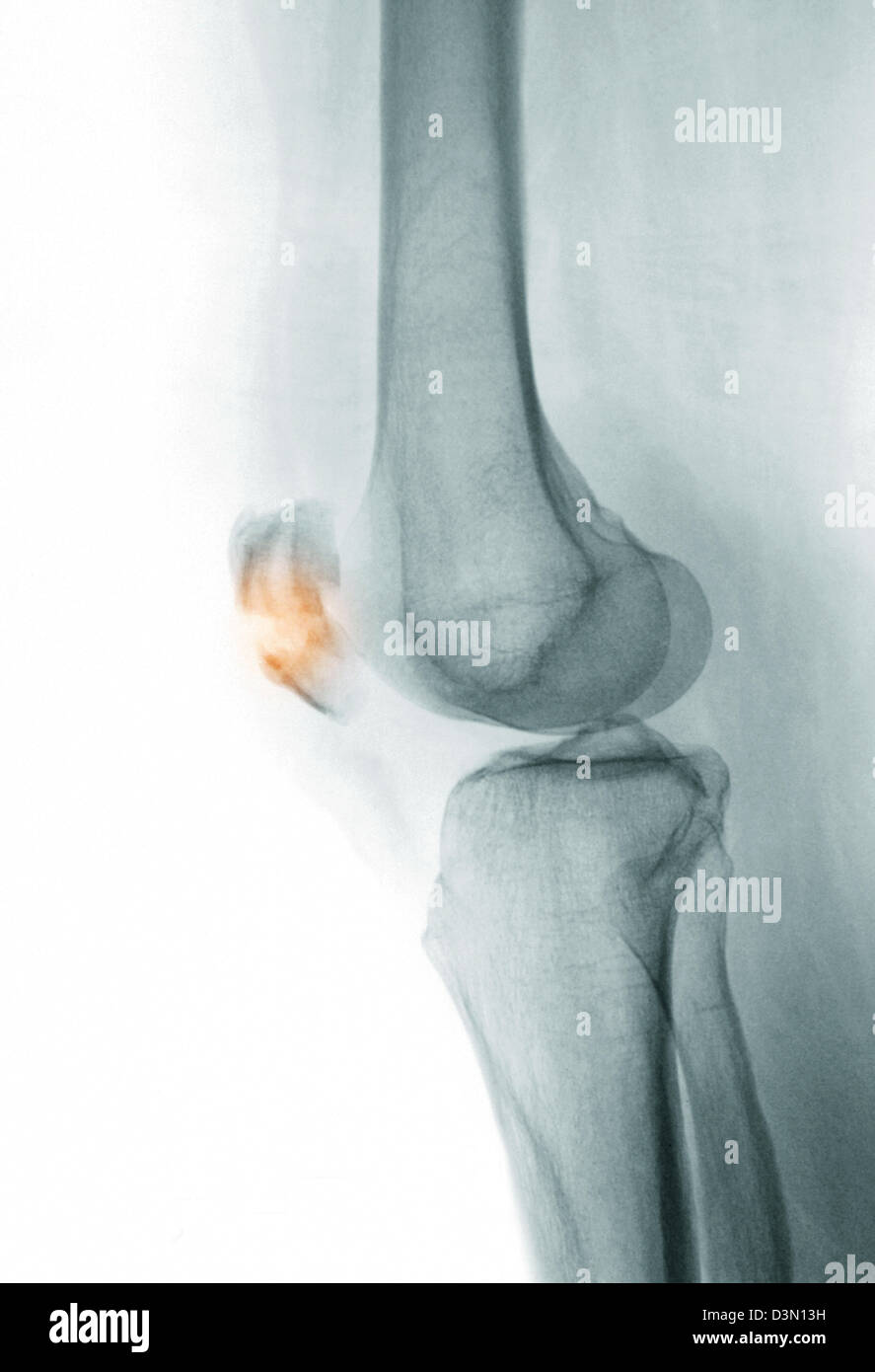 Kneecap hi-res stock photography and images - Alamy