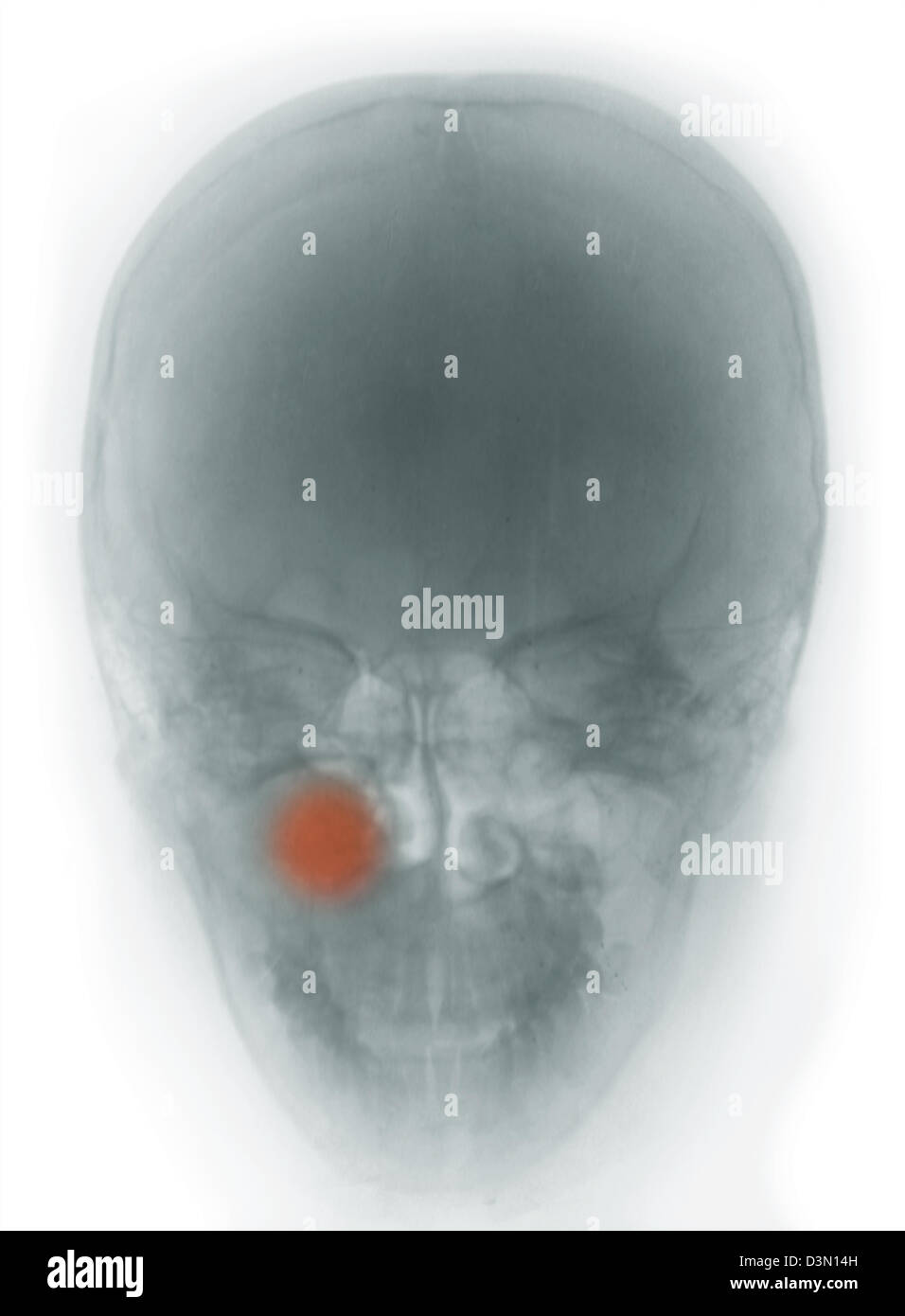 X-ray showing a maxillary sinus tumor Stock Photo - Alamy