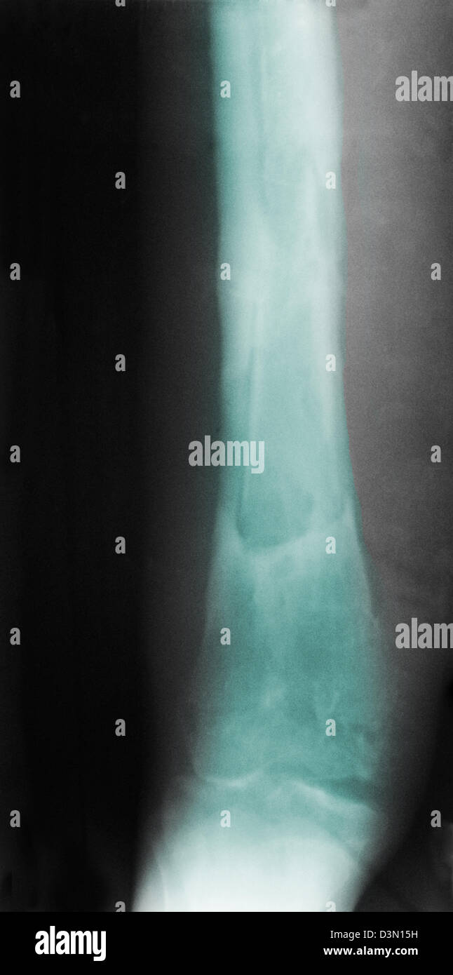 X-ray showing osteomyelitis of the tibia from an open fracture Stock ...
