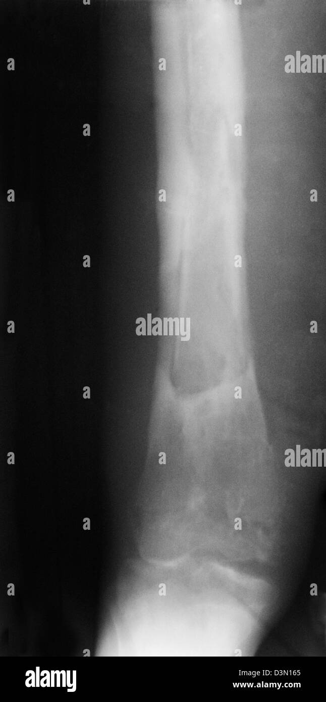 X-ray showing osteomyelitis of the tibia from an open fracture Stock ...