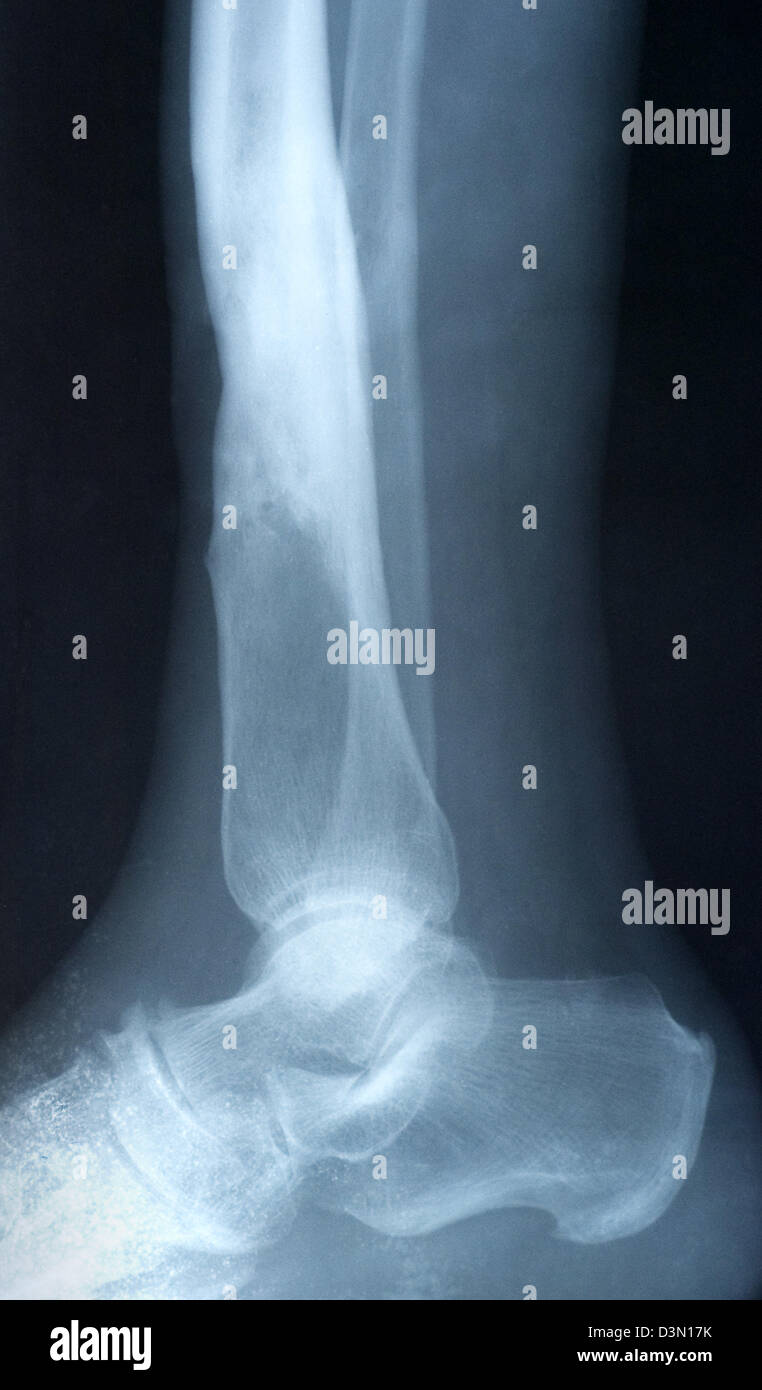 X-ray showing osteomyelitis of the tibia from an open fracture Stock ...