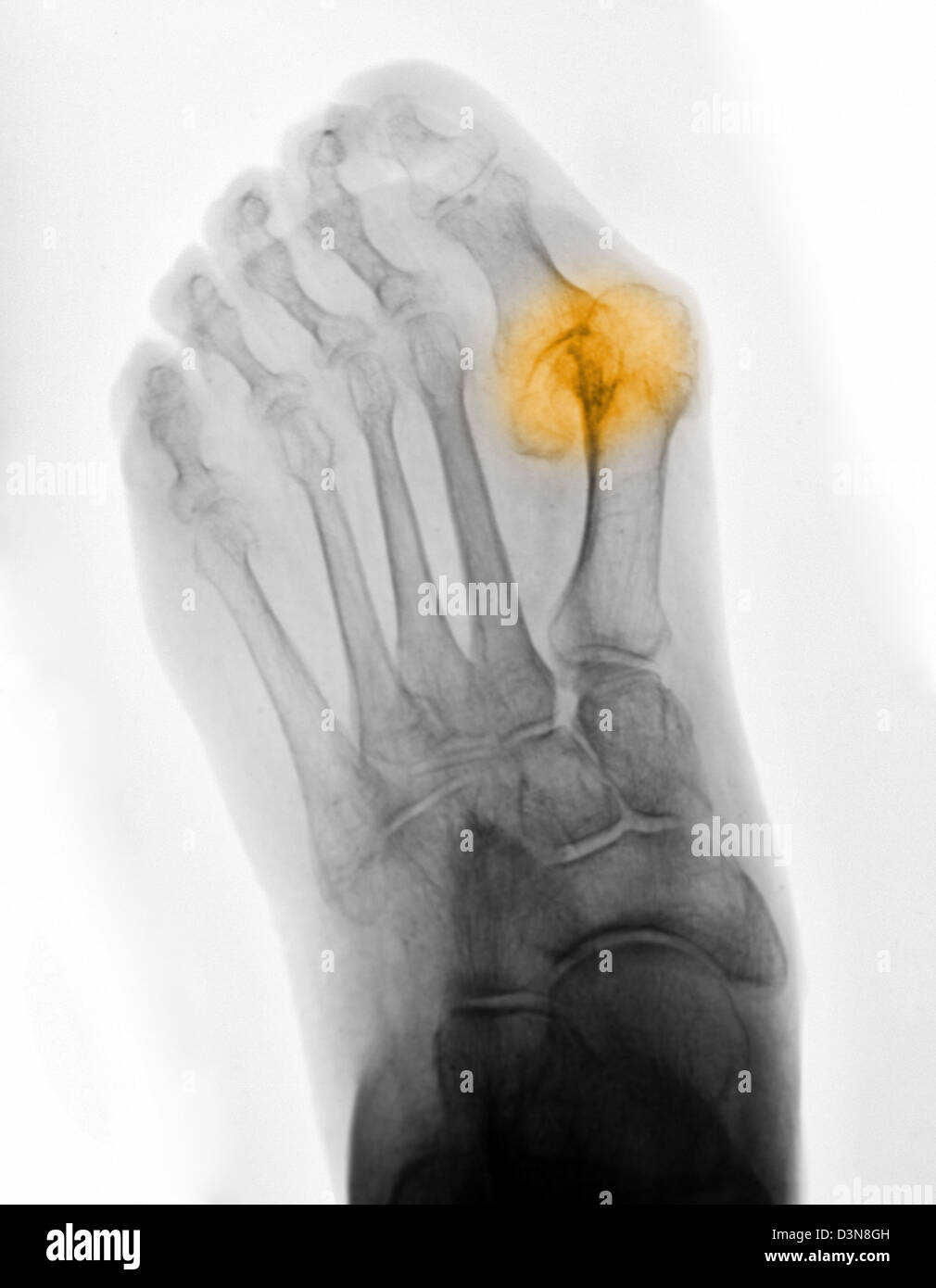 X-ray of the foot of an 83 year old woman showing a severe bunion ...