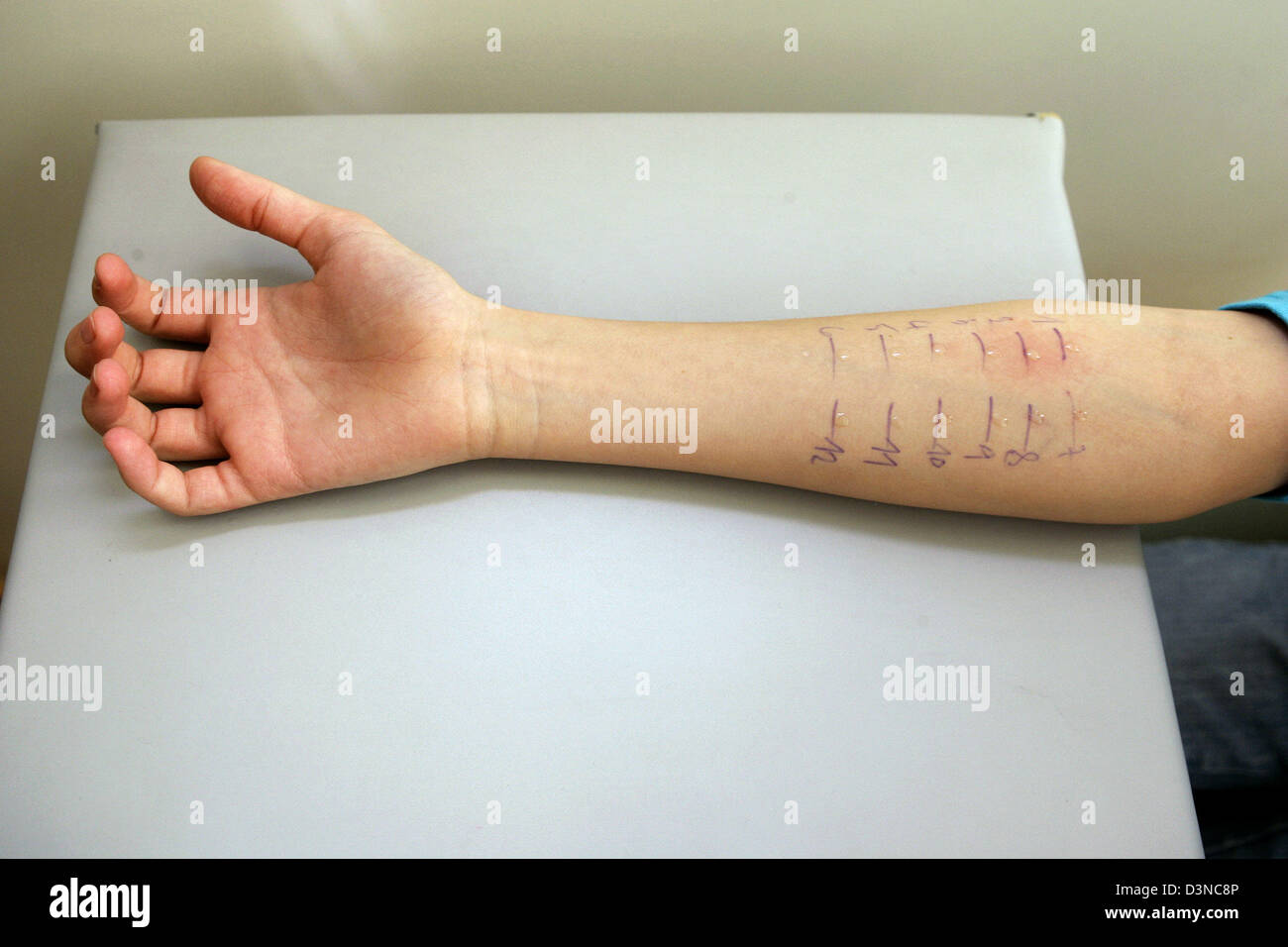 The picture shows an allergy test (Prick test) on the forearm of a ten ...