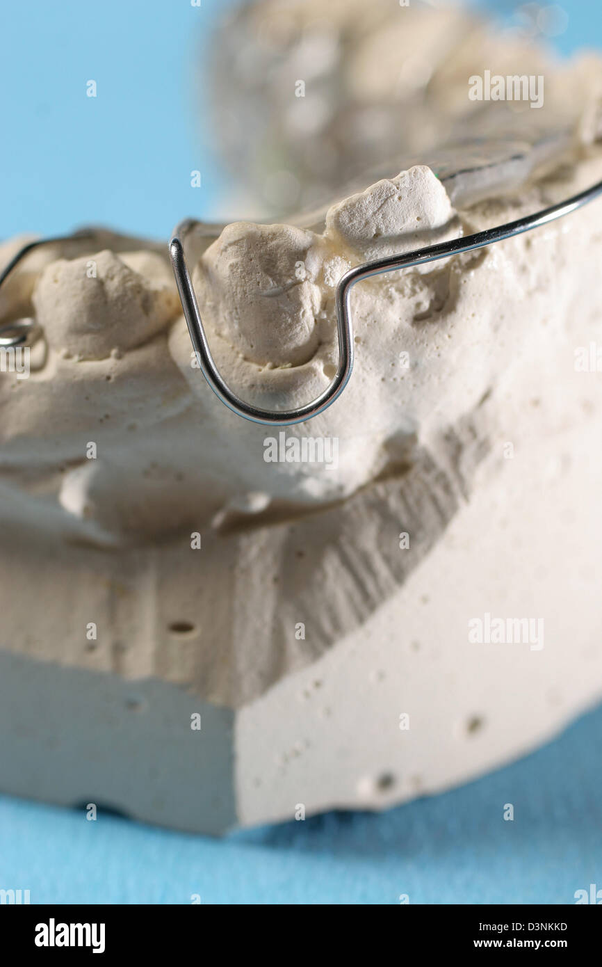 The photo shows a plaster model of teeth with an adapted brace ...
