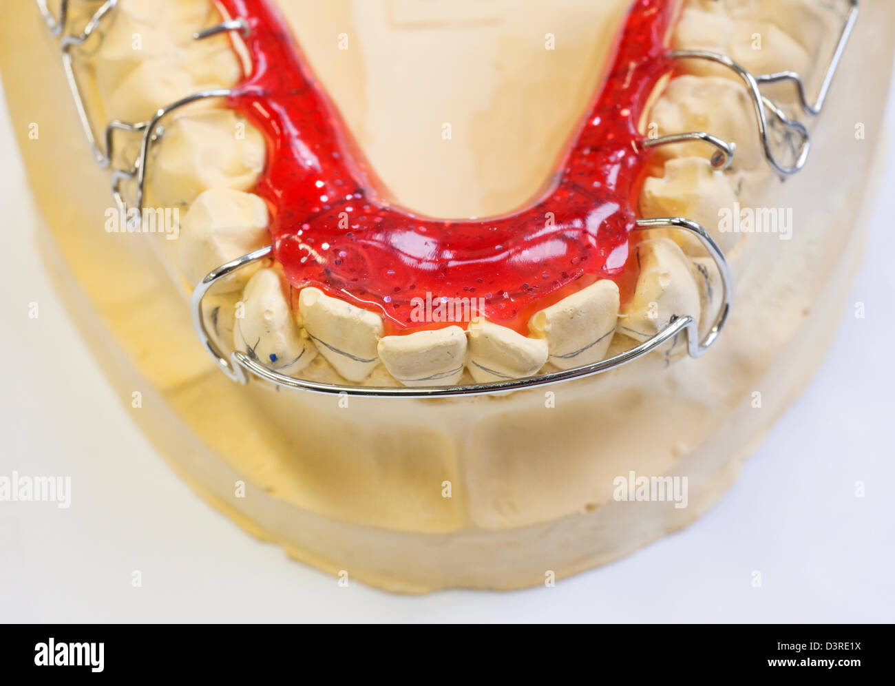 Berlin, Germany, braces against tooth and jaw deformities Stock Photo ...