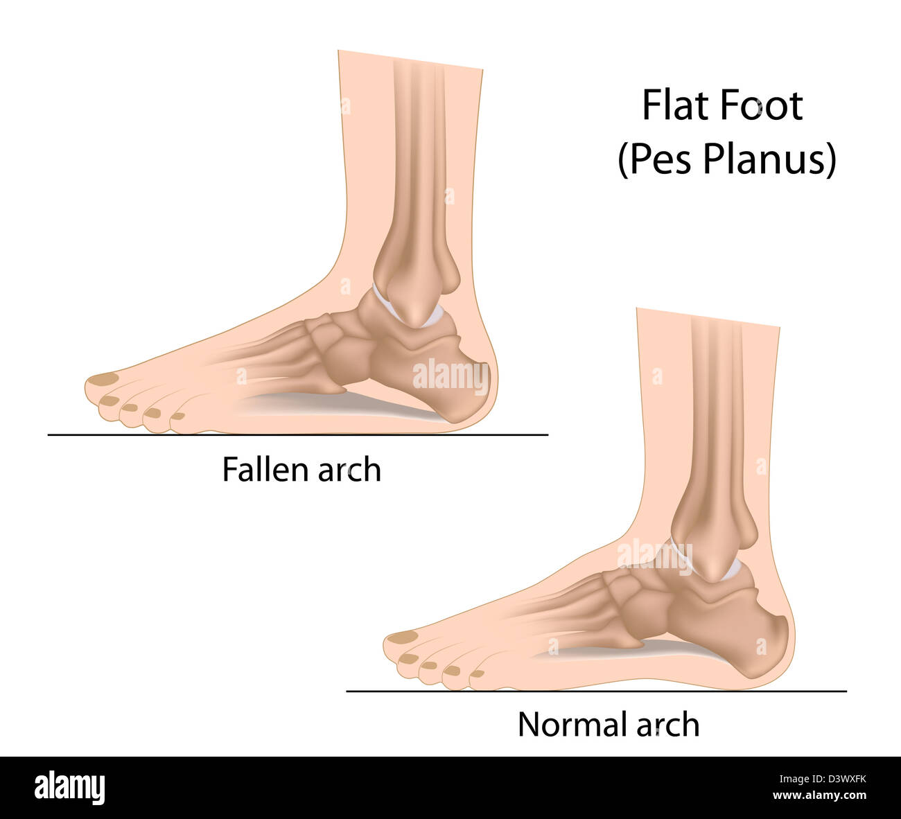 Flatfoot normal hi-res stock photography and images - Alamy