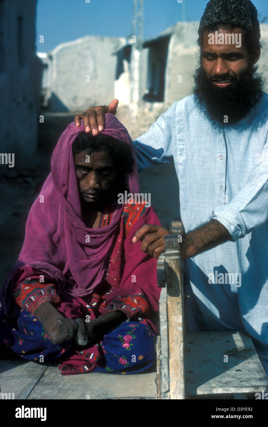 Woman leprosy patient who has lost her fingers to the disease with ...