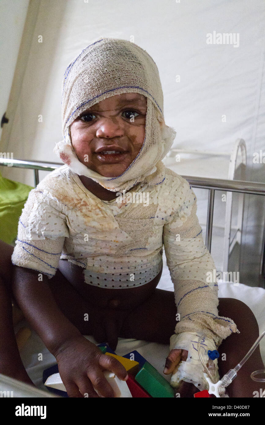 a child in the burn unit in Drouillard Hospital MSF Port-au-Prince ...