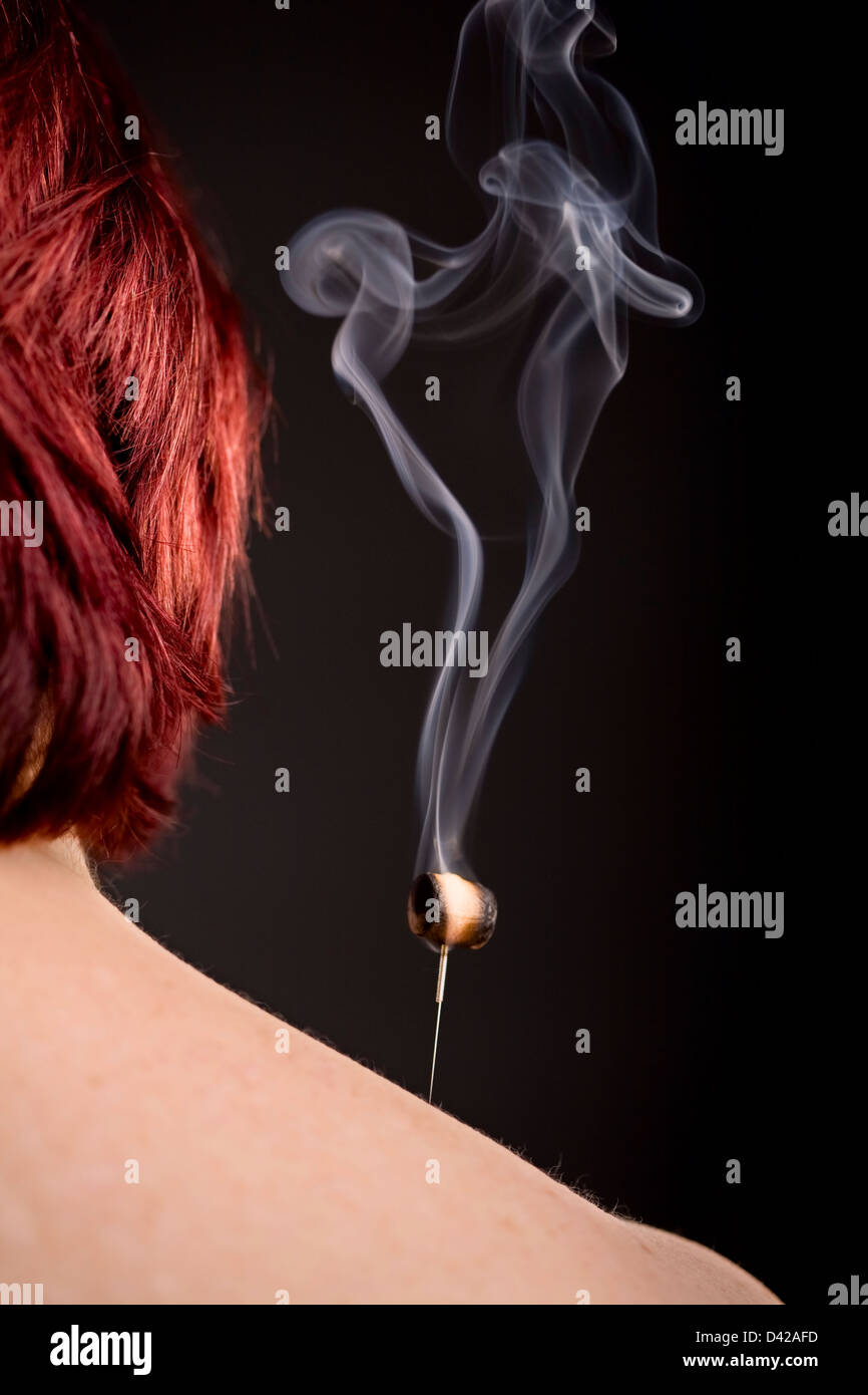 Moxa acupuncture hi-res stock photography and images - Alamy