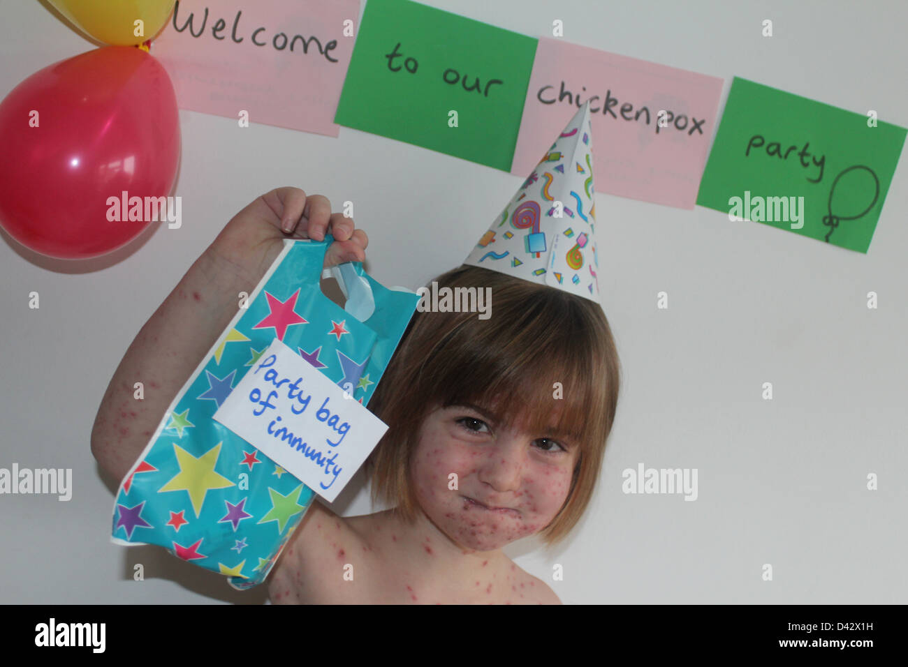 Chickenpox disease hi-res stock photography and images - Alamy