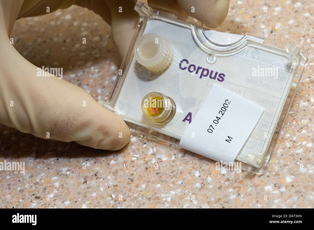 A biopsy tissue sample retrieved in an endoscopic procedure Stock Photo ...