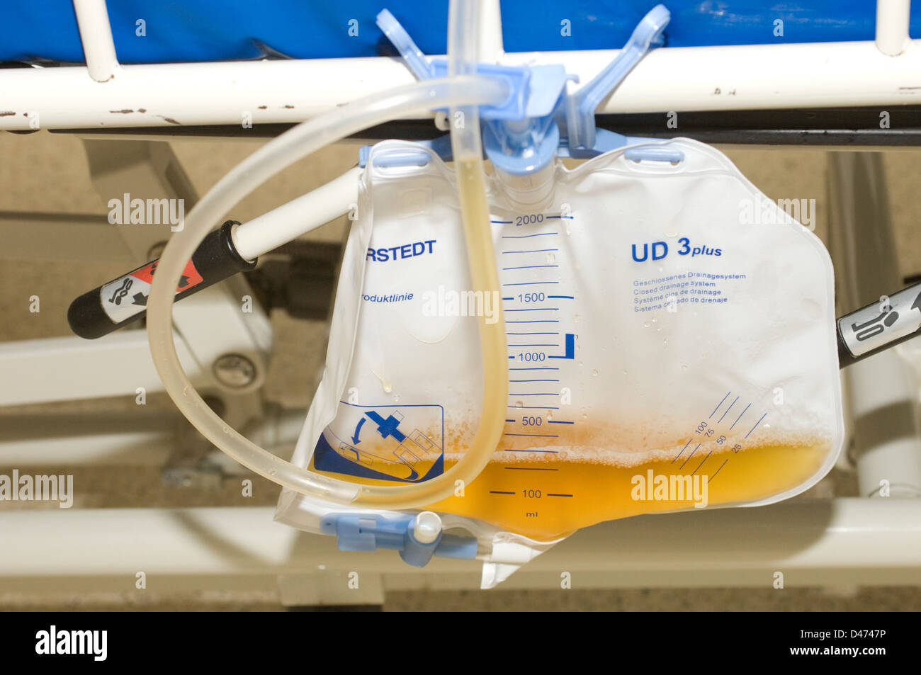 A bag containing urine collected by a catheter inserted into the ...