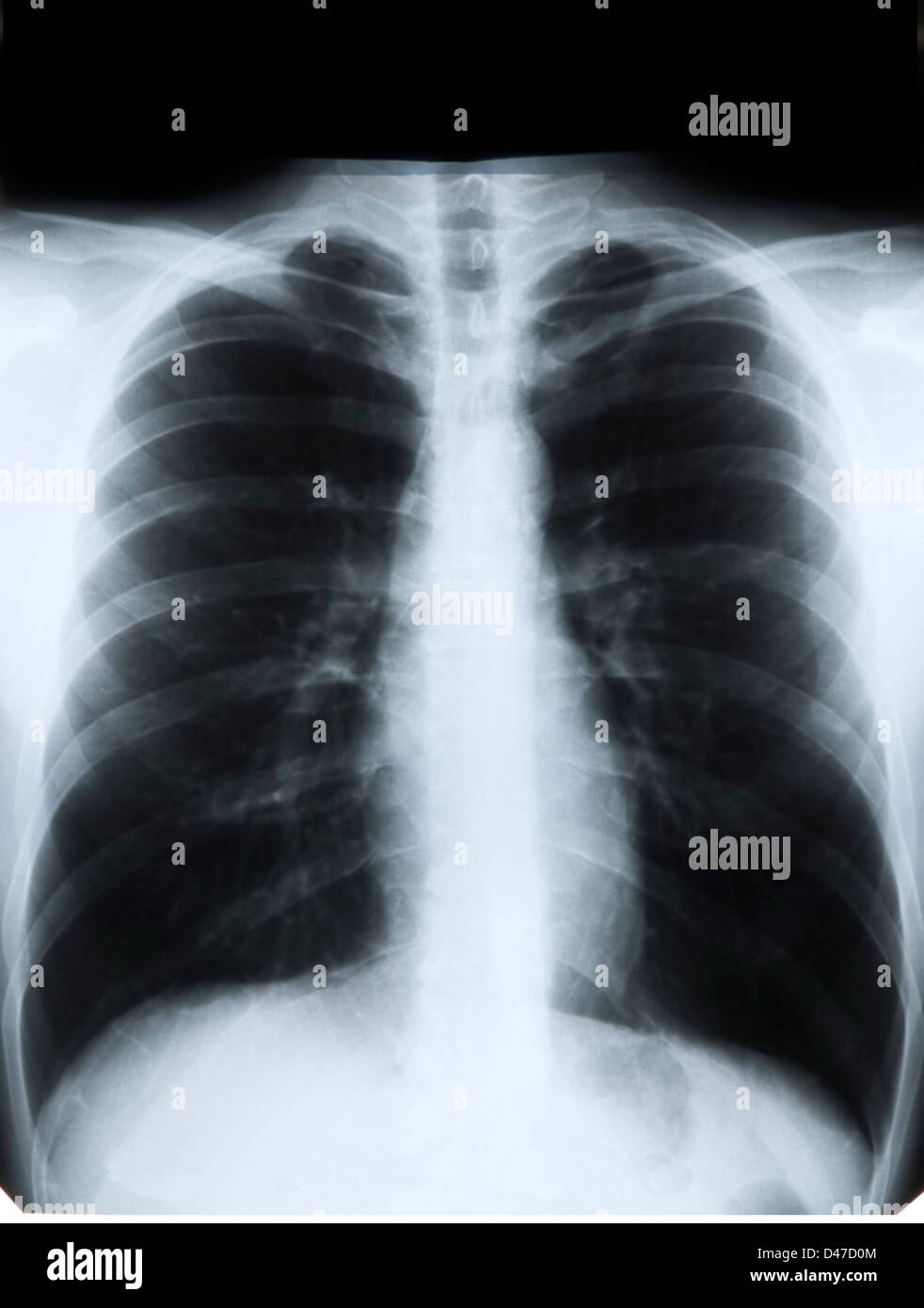 X-ray of chest, close up Stock Photo - Alamy