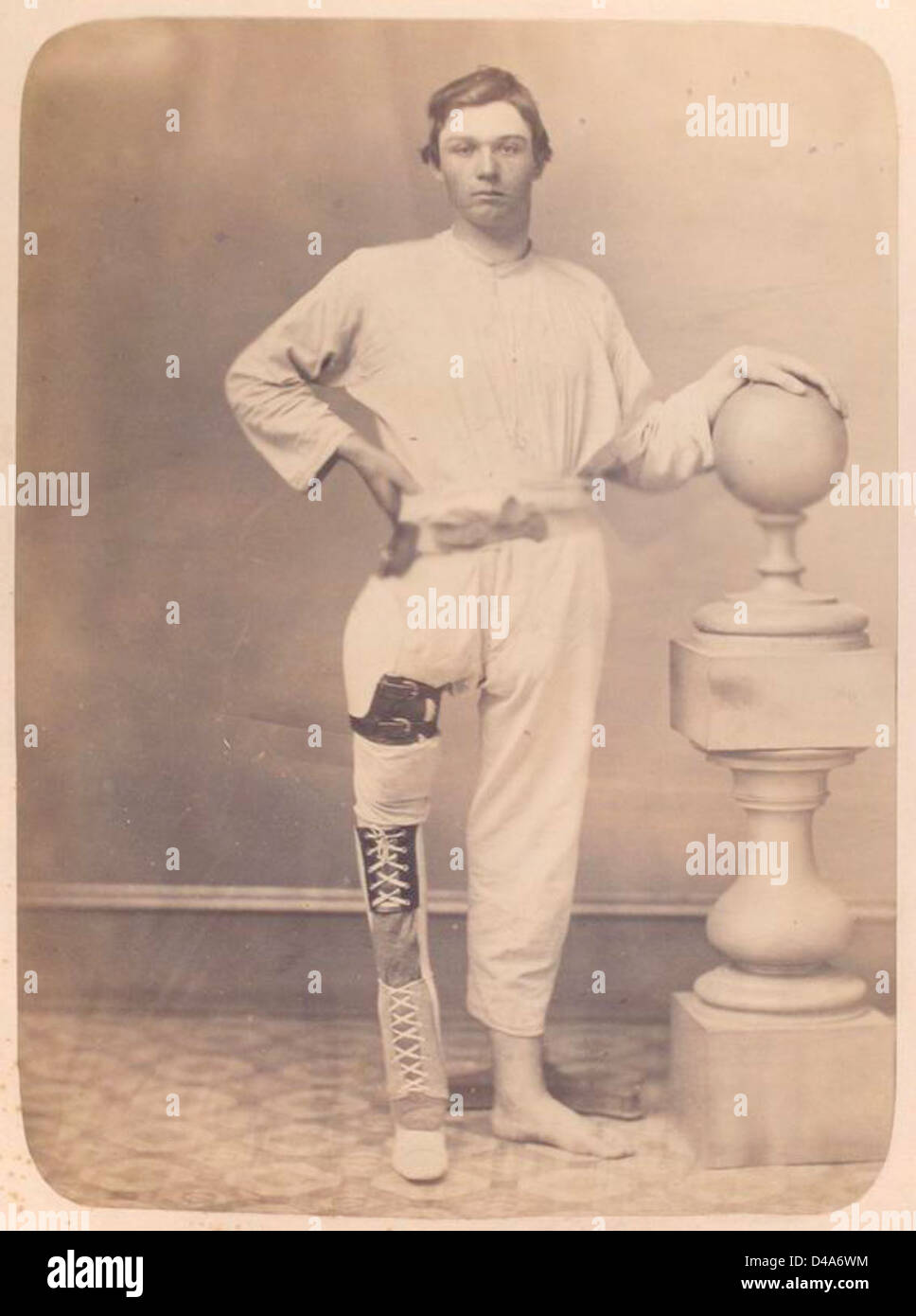 A man with a shortened right leg stands facing the camera, his leg ...