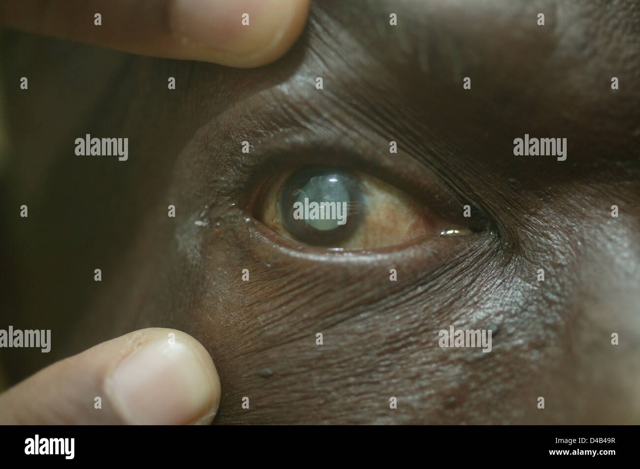 Male patient's eye with mature cataract, Close-up Stock Photo - Alamy