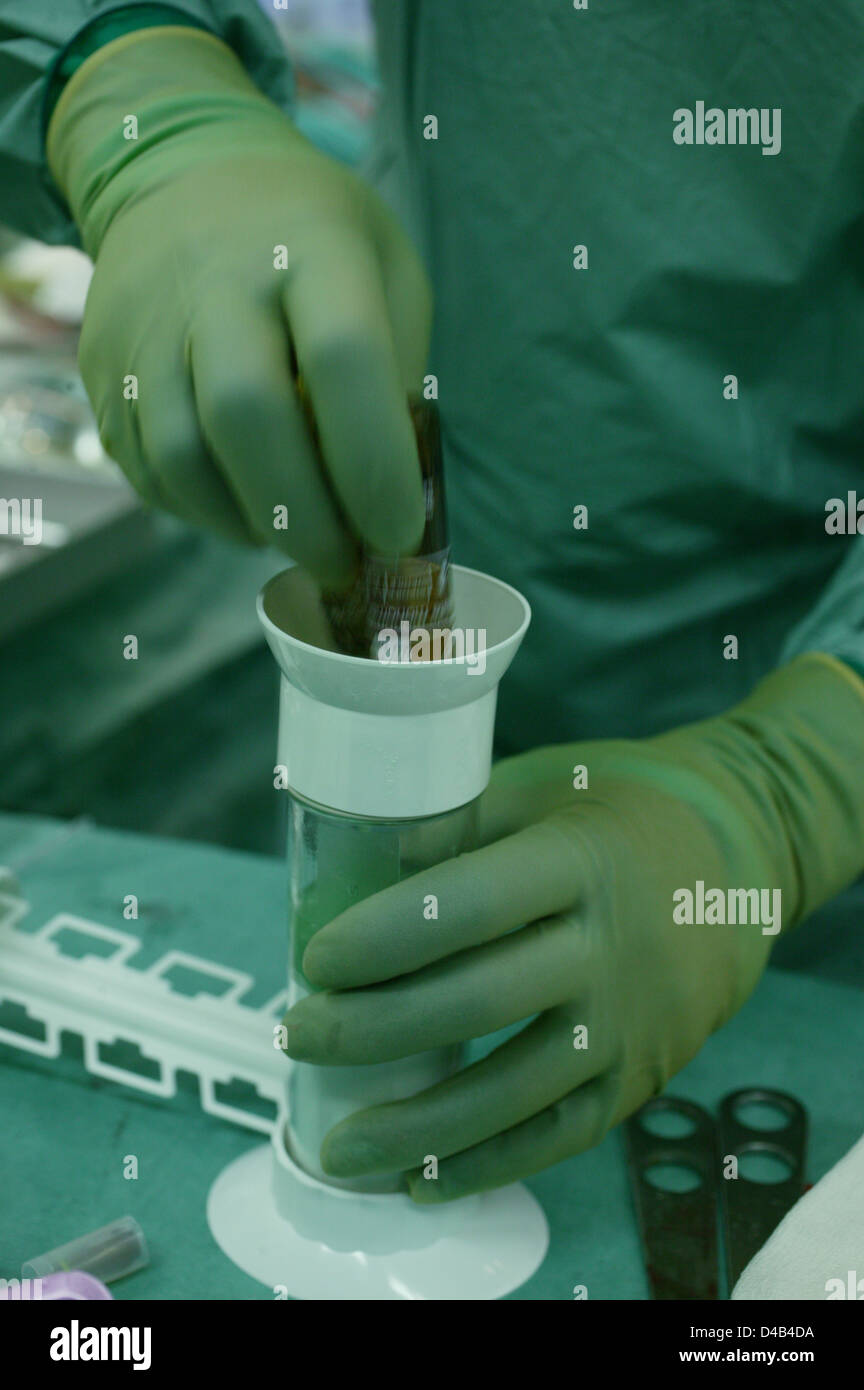 Orthopedic cement being mixed during Hemiarthroplasty, Close-up. UK ...