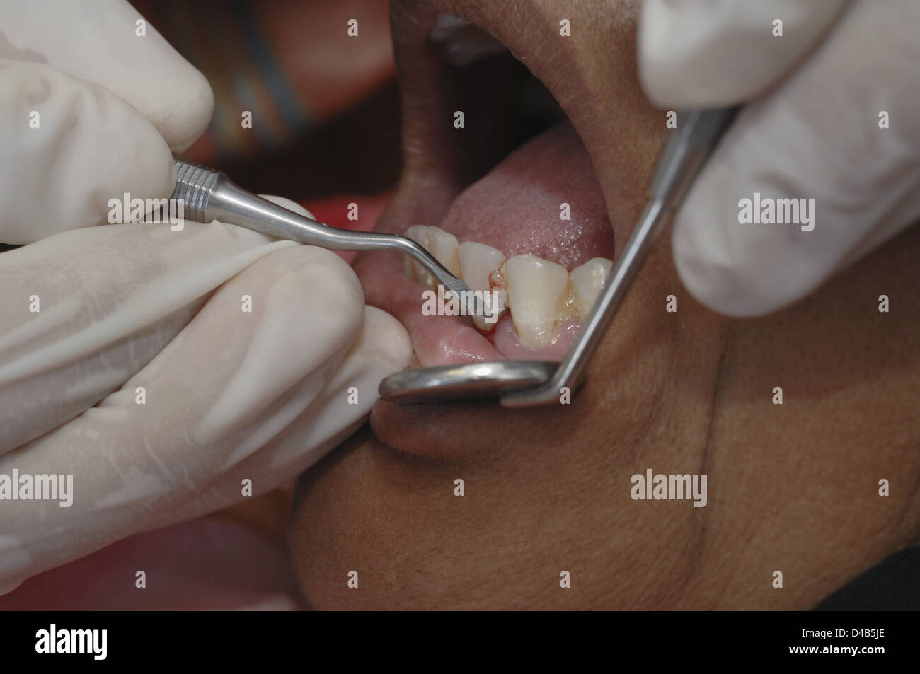 Plaque and tartar, if not removed daily can build up over time and ...