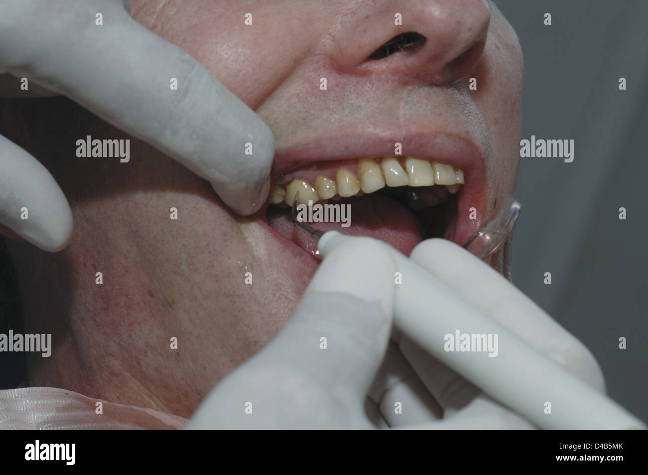 Dental Plaque Removal Video