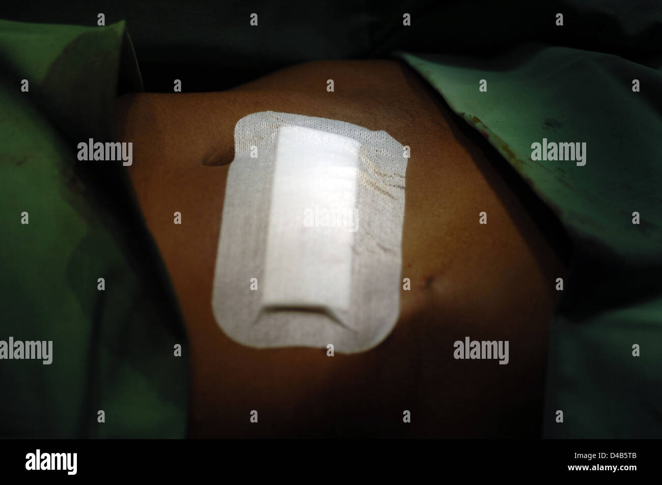 Appendectomy hi-res stock photography and images - Alamy