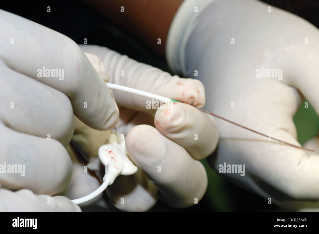 Central venous catheter insertion hi-res stock photography and images ...