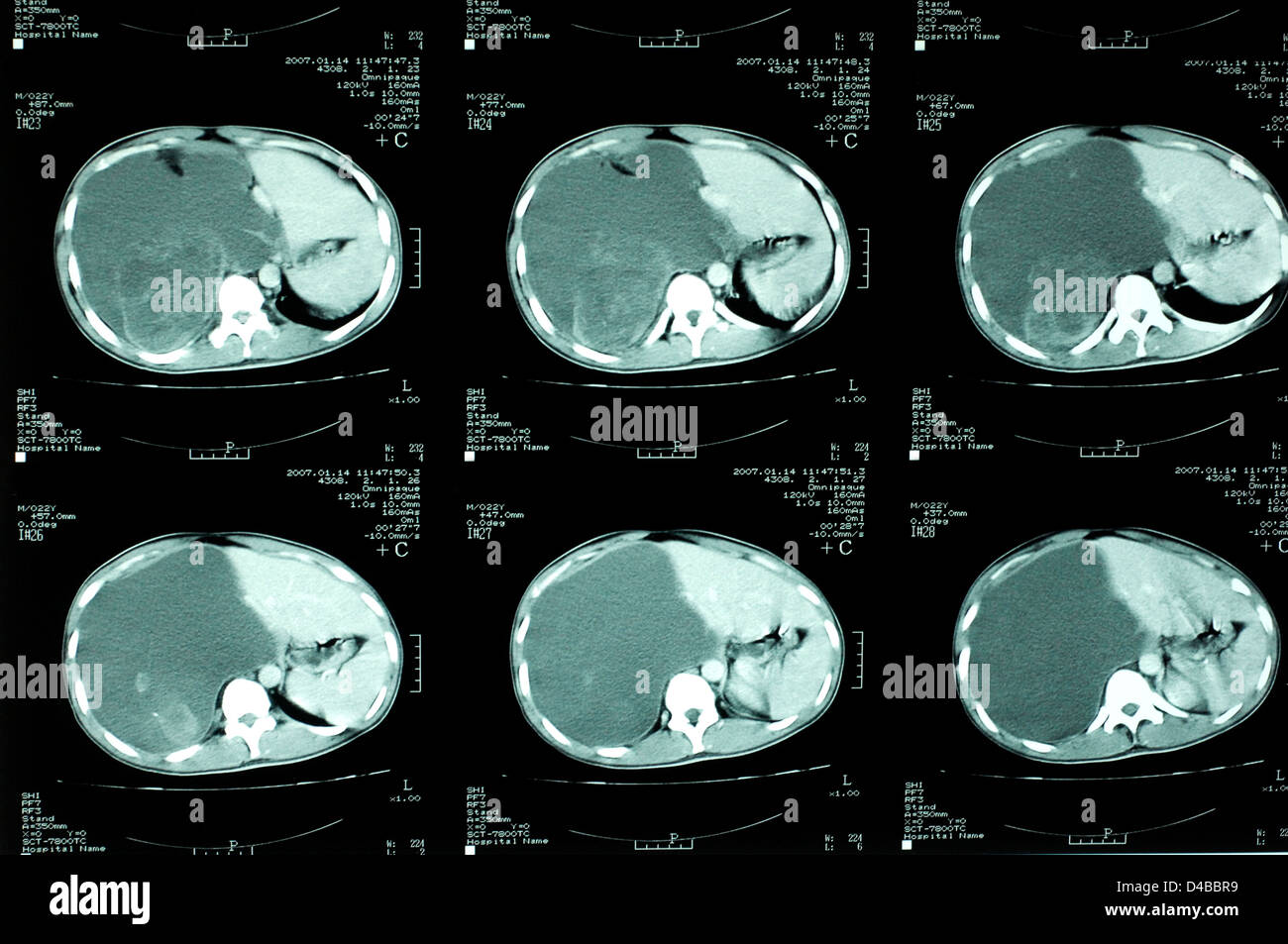 Radiology. CT scan showing a blood pooling on the right side of a ...
