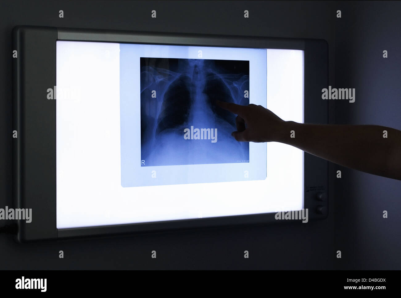 X-ray of patients chest being reviewed on illuminated wall-mounted ...