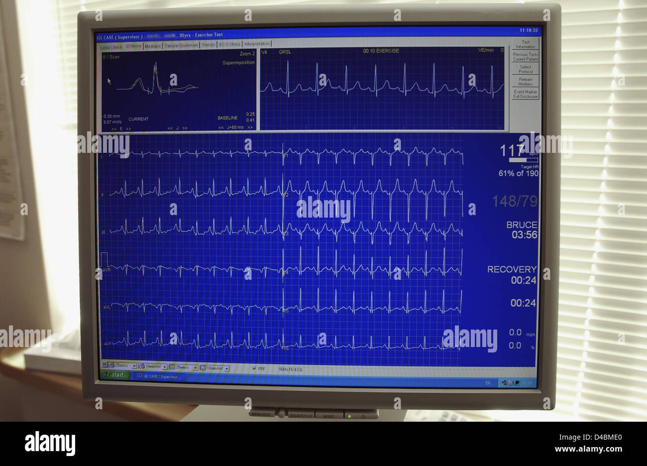 ECG screen read out Stock Photo - Alamy