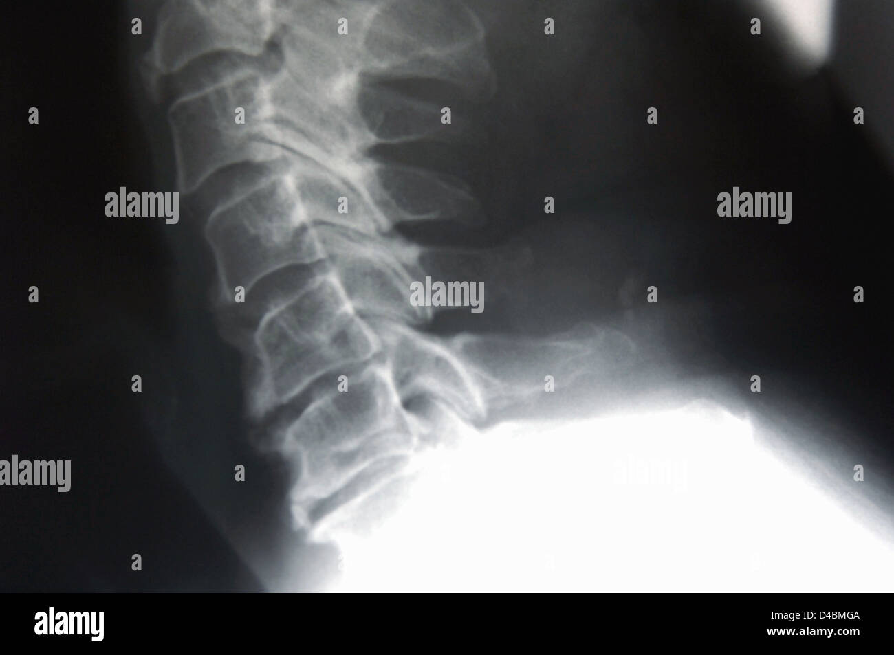 X-ray image of female lumbar vertibrae Stock Photo - Alamy
