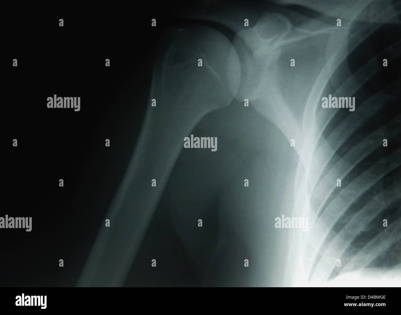 X ray image female clavical scapula upper humerous hi-res stock ...
