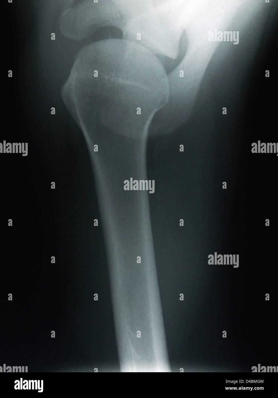 X ray image of female scapula and upper humerous hi-res stock ...