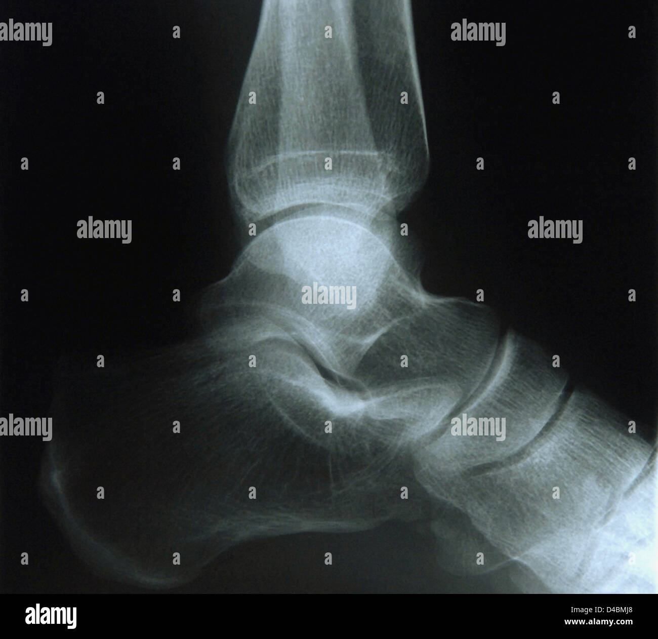 X-ray image of female knee joint, with knee cap Stock Photo - Alamy